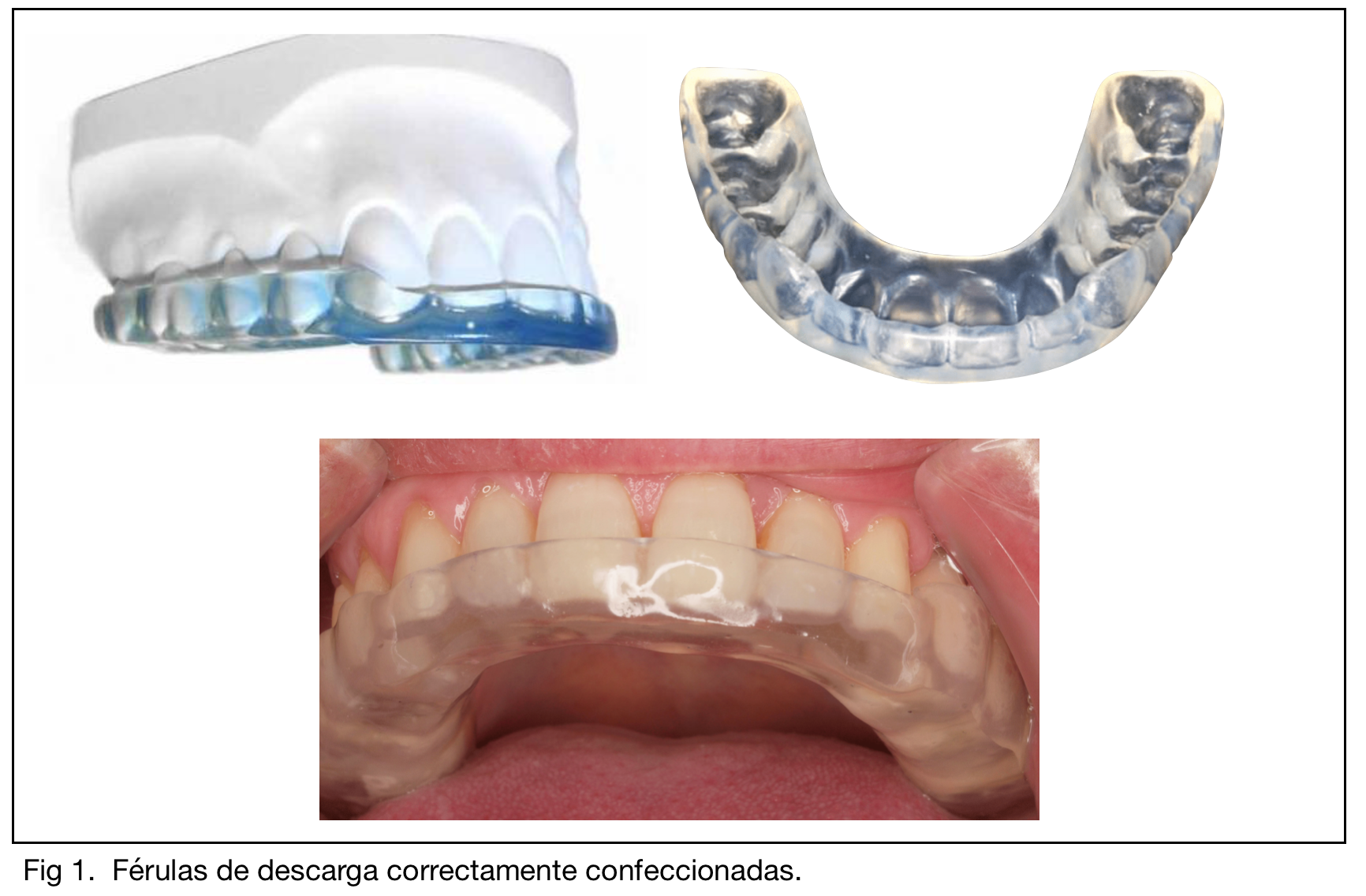 ᐈ que bruxismo que necesaria une ferula descarga tratarlo [ 2025 ...